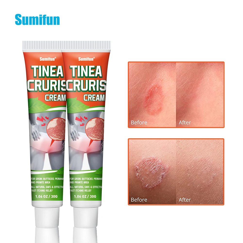 Sumifun-Tinea-Cruris-Treatment-Anti-Itch-Chinese-Medicine-Herbal ...