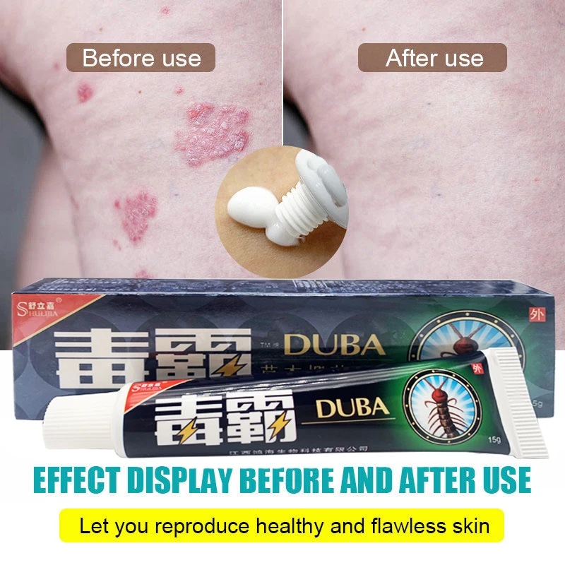 2pcs-15g-Psoriasis-Ointment-Eczema-Antibacterial-Cream-Dermatitis ...