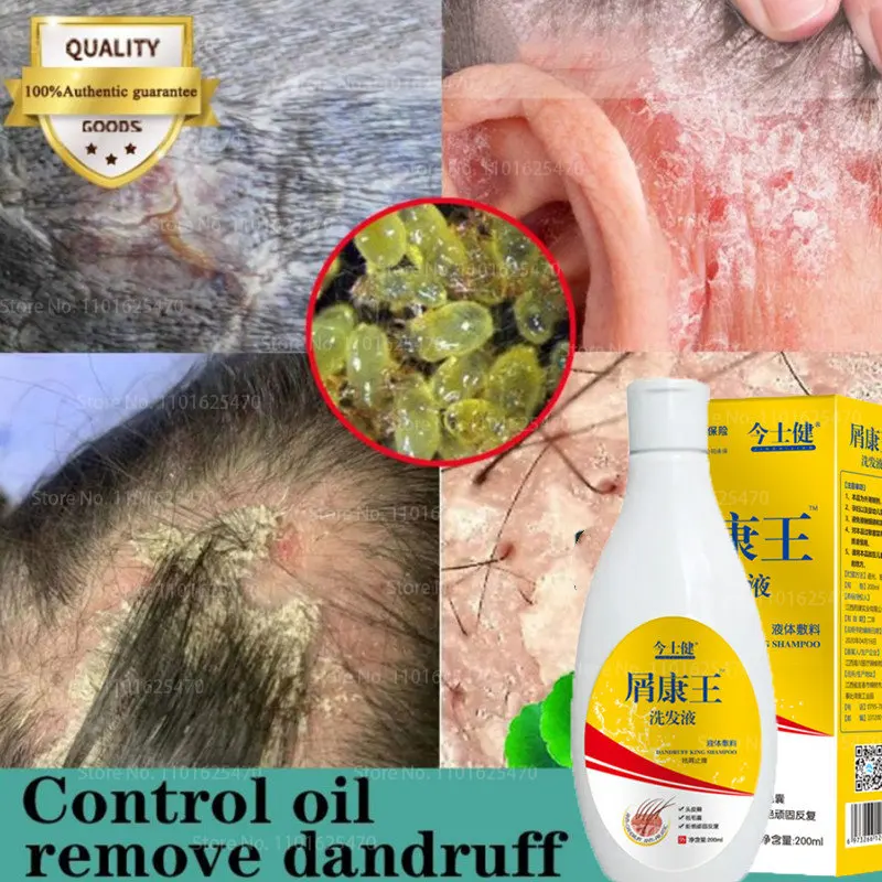 200mlAnti dandruff, Mite relieving, Anti itching, Oil controlling ...