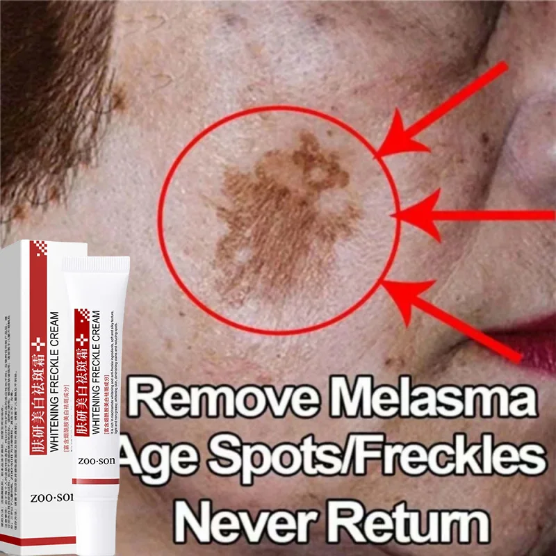 Face-Melasma-Cream-Brighten-Dark-Skin-Emulsion-Lightening-Melanin ...