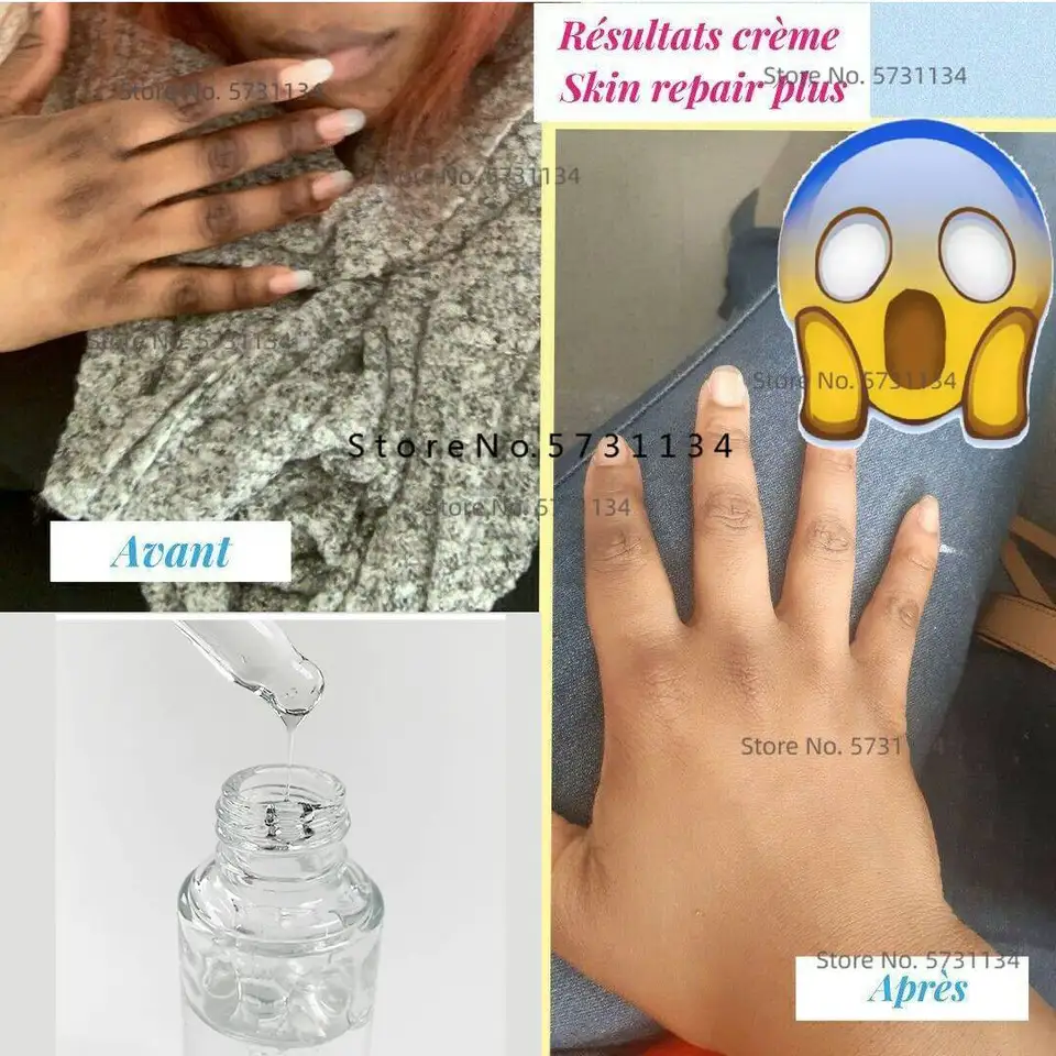 Hyperpigmentation Hands