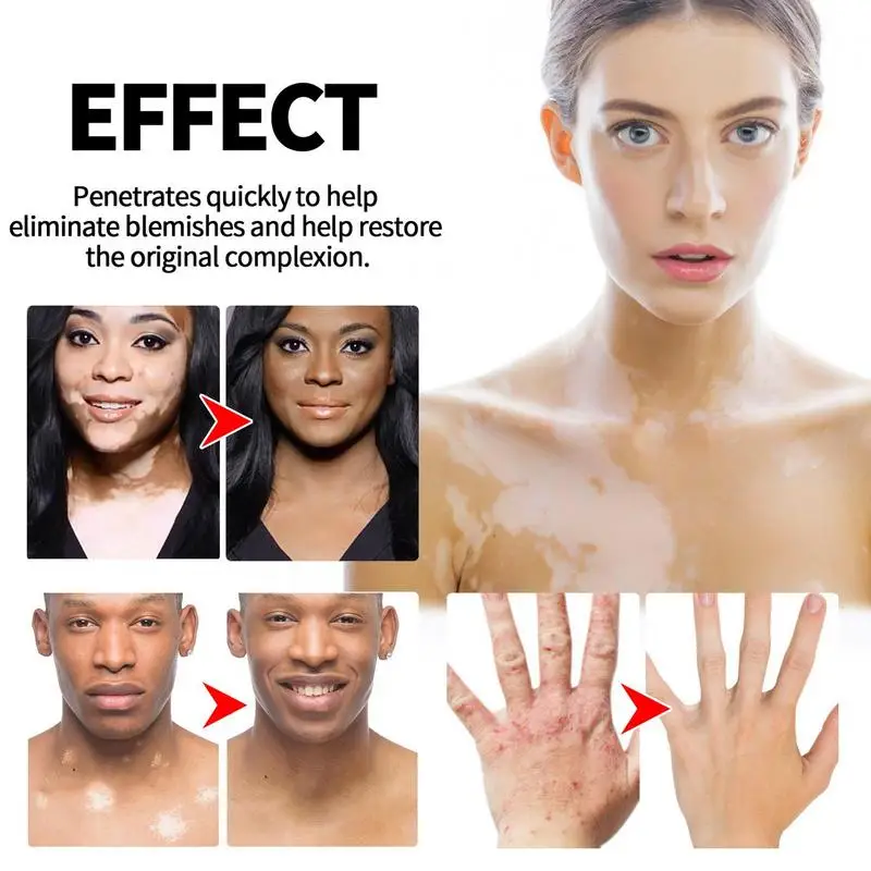 Skin Pigment Melanin