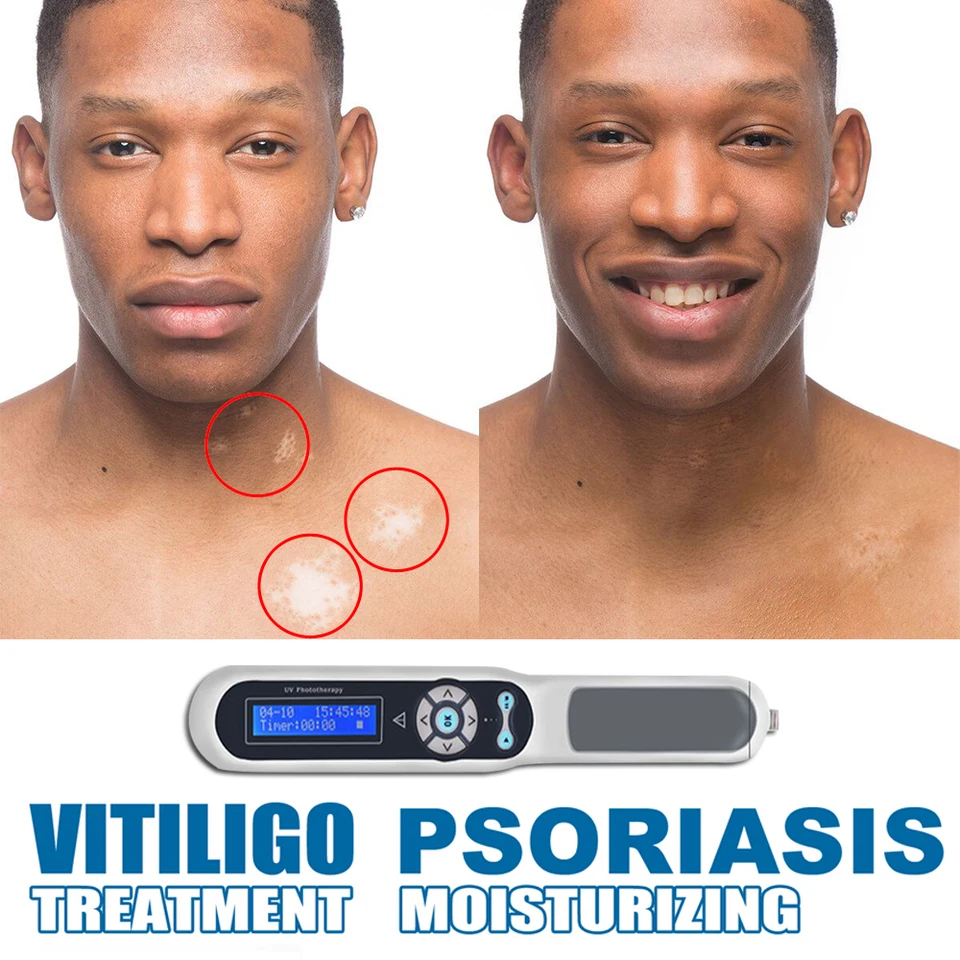 Psoriasis Treatment Phototherapy