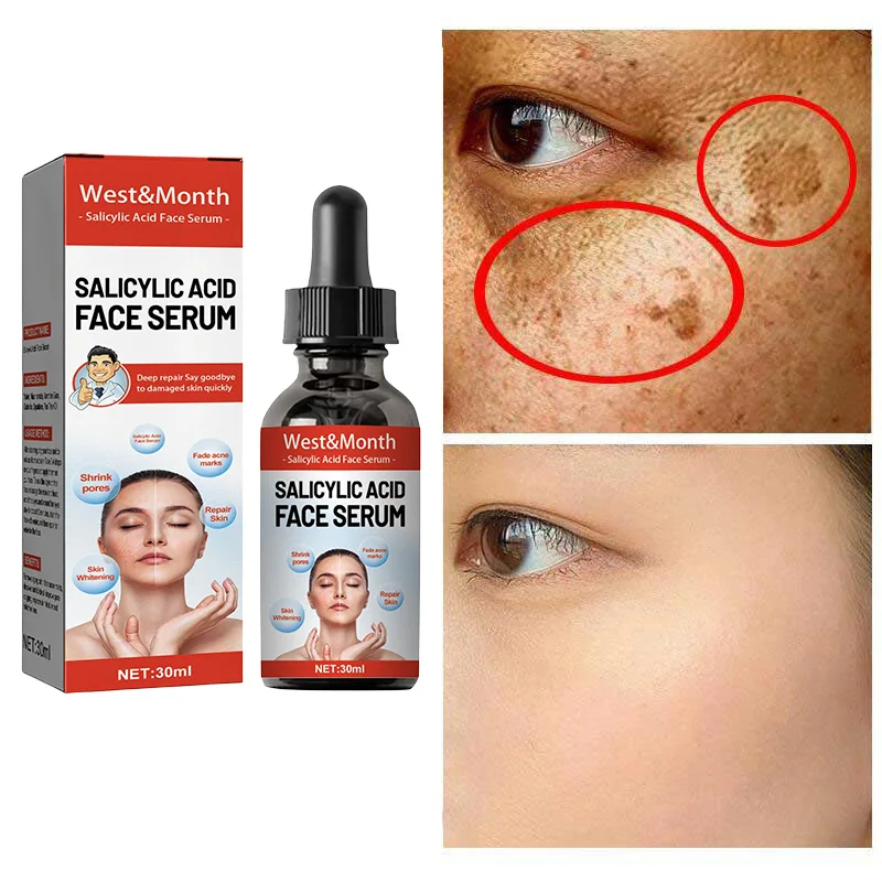 Nicotinamide-Freckle-Removal-Serum-Attenuates-Stains-Facial-Salicylic ...