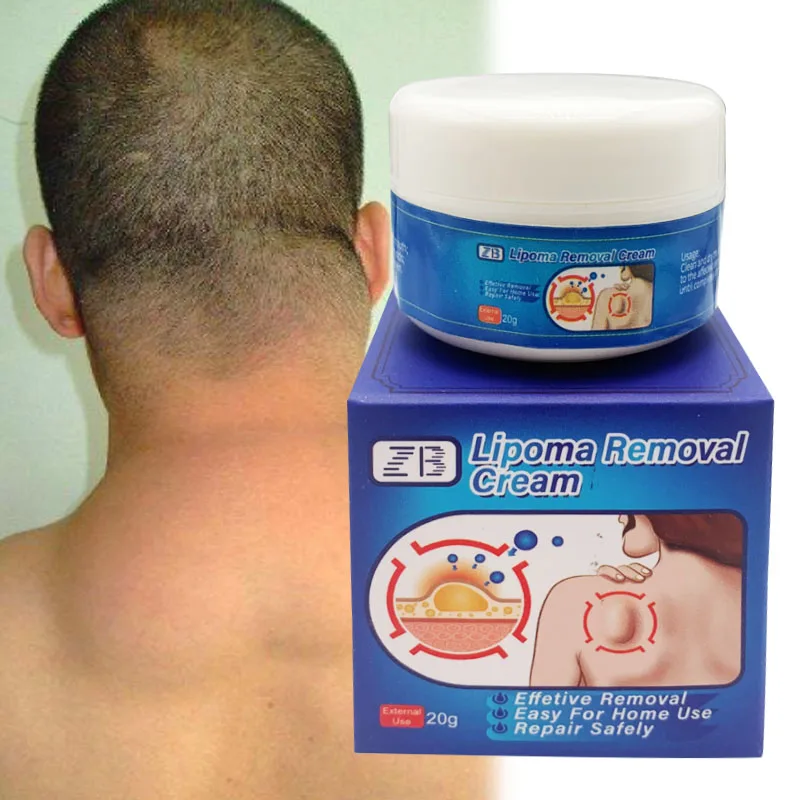 Zb Lipoma Removal Cream Antitumor Remove Fat Lump Ointment Nodular ...