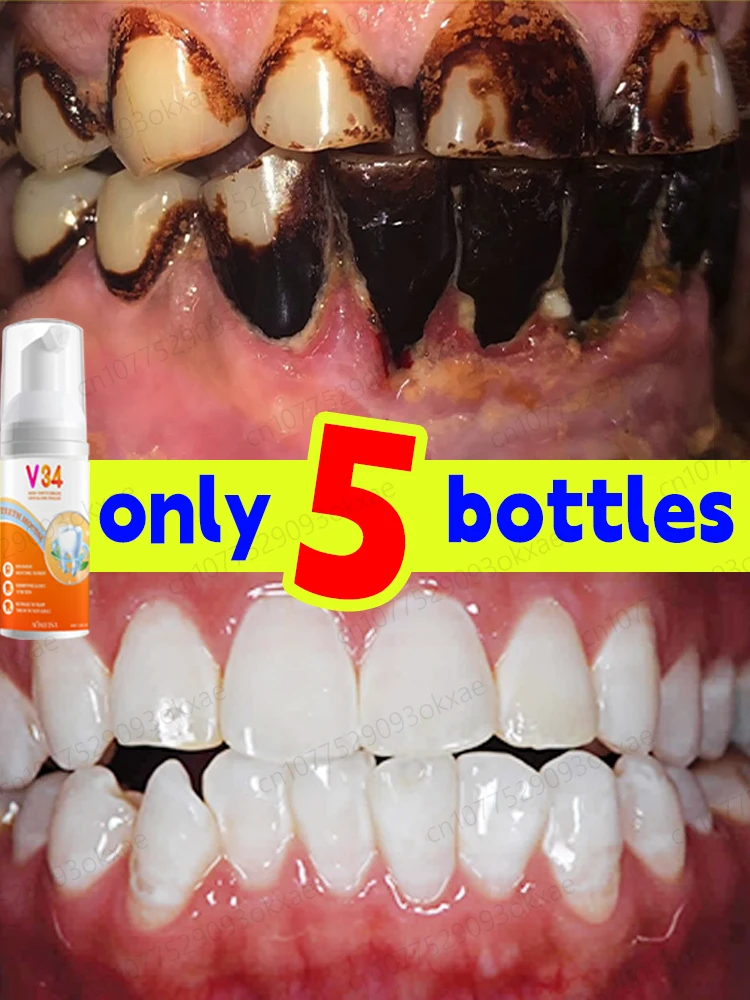 Cavities Bad Breath