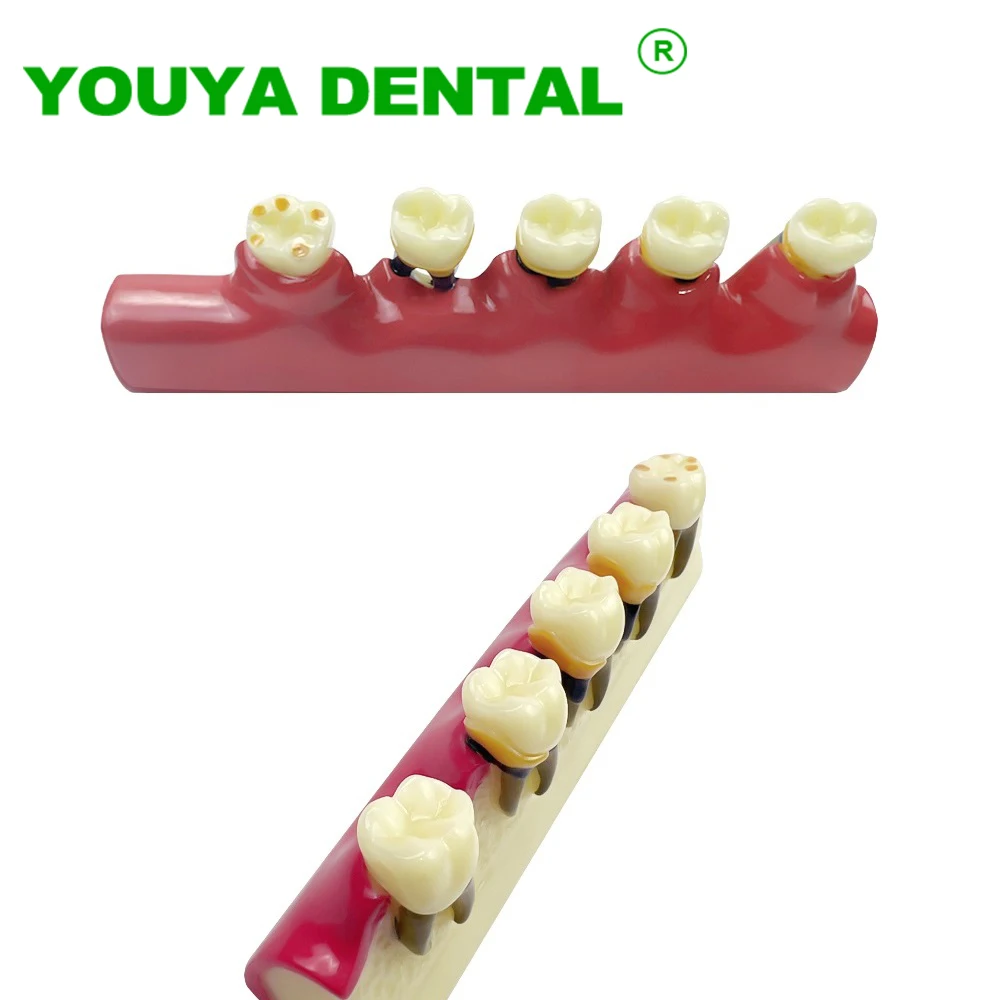 Teeth-Periodontal-Disease-Model-Dental-Caries-Breakdown-Display ...