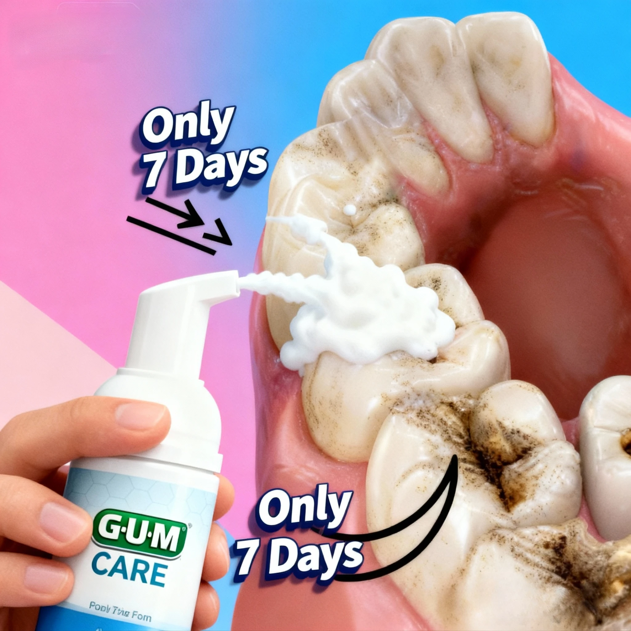 Mousse Shield, No Way To Decay.,Intraoral Mousse Clean Tools ...
