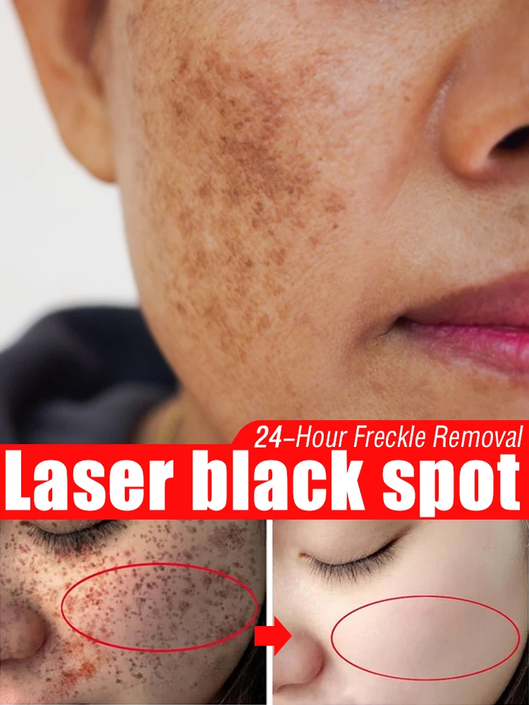 Effective-freckle-removing-removes-black-spots-lightens-facial-freckles ...