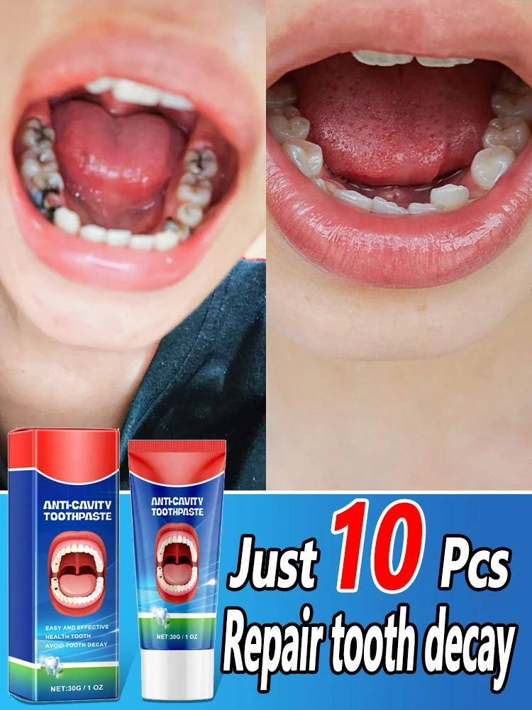 Dental Caries Repair Cream Prevent Tooth Decay Protect Teeth