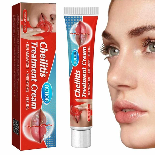 Ringworm Treatment Cream