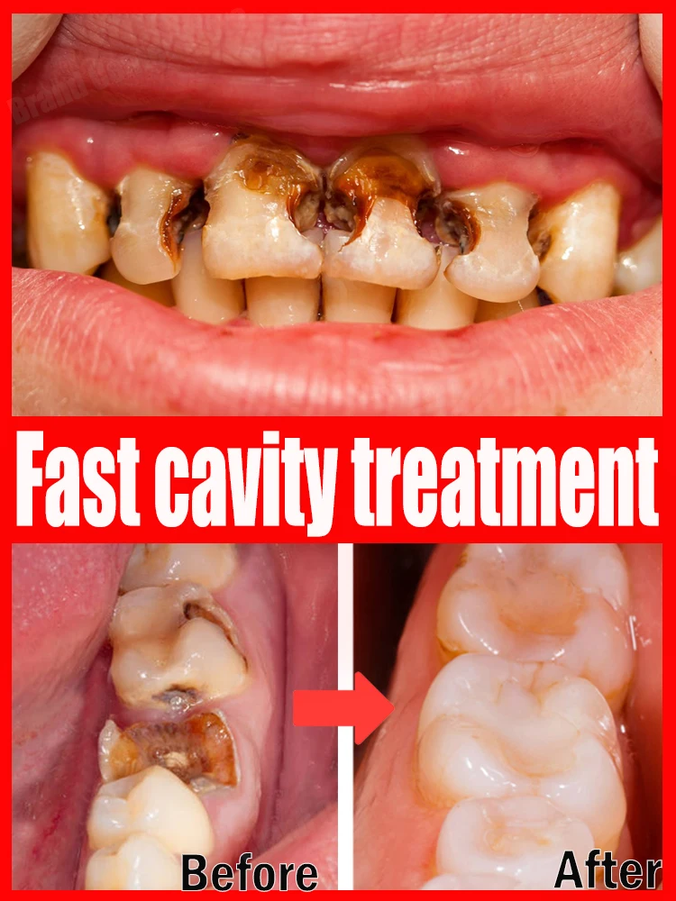 repair-Tooth-decay-protect-teeth-all-cavities.jpg