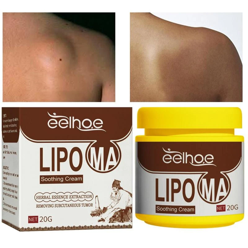 Lipoma Removal Cream Lipolysis Fat Lump Relief Cream Skin Swelling Fat ...