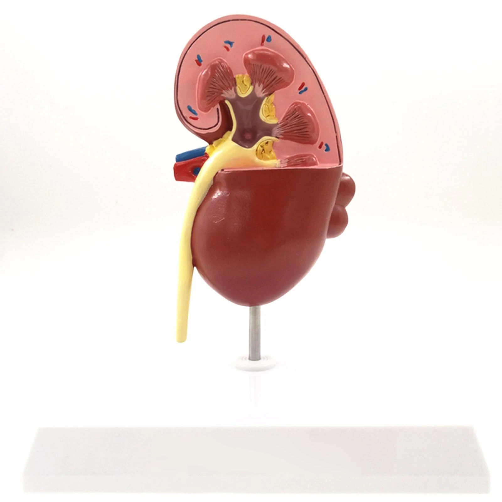 PVC Diseased Kidney Model Human Anatomical Medical Pathological Changes ...
