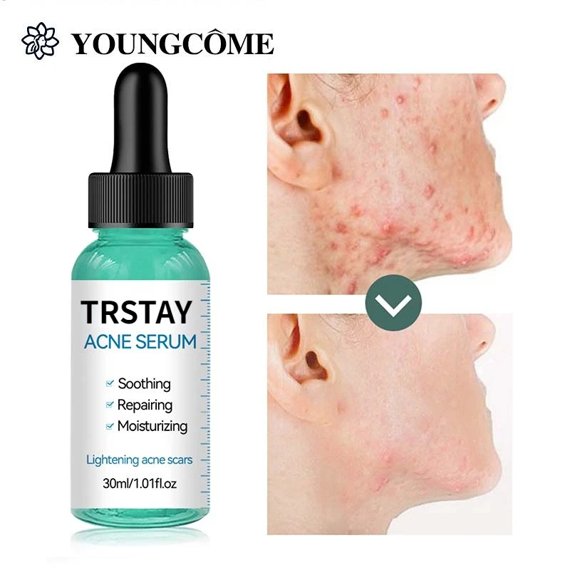 Herbs-Face-Serum-Acne-Treatment-Essence-Pimple-Removal-Moisturizing ...