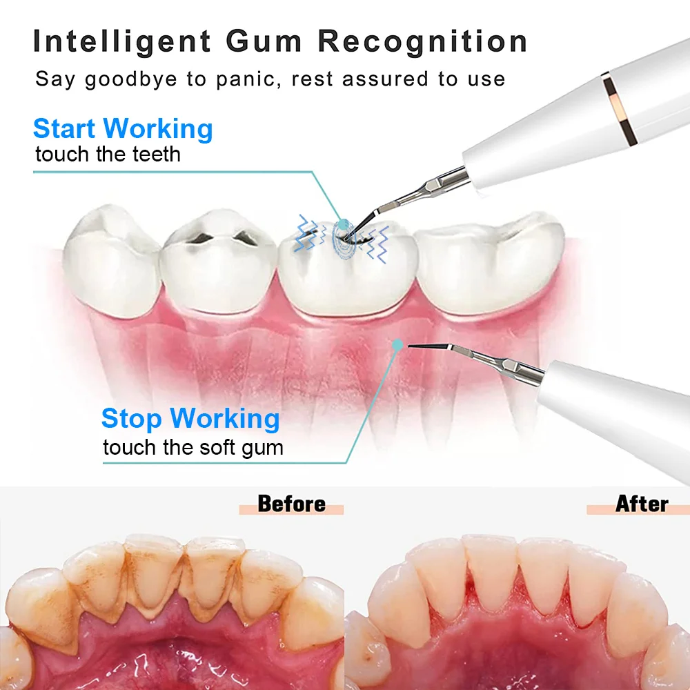 Home Dental Scaler