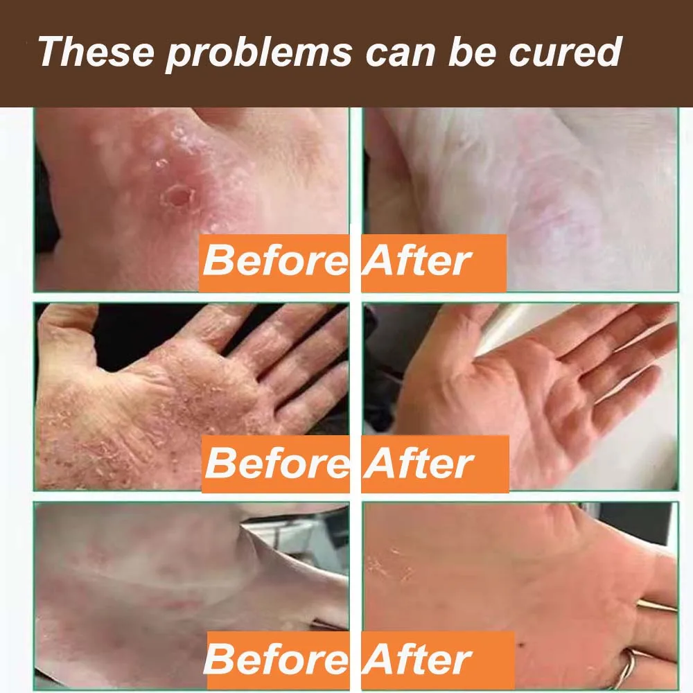 Herpetic Folliculitis