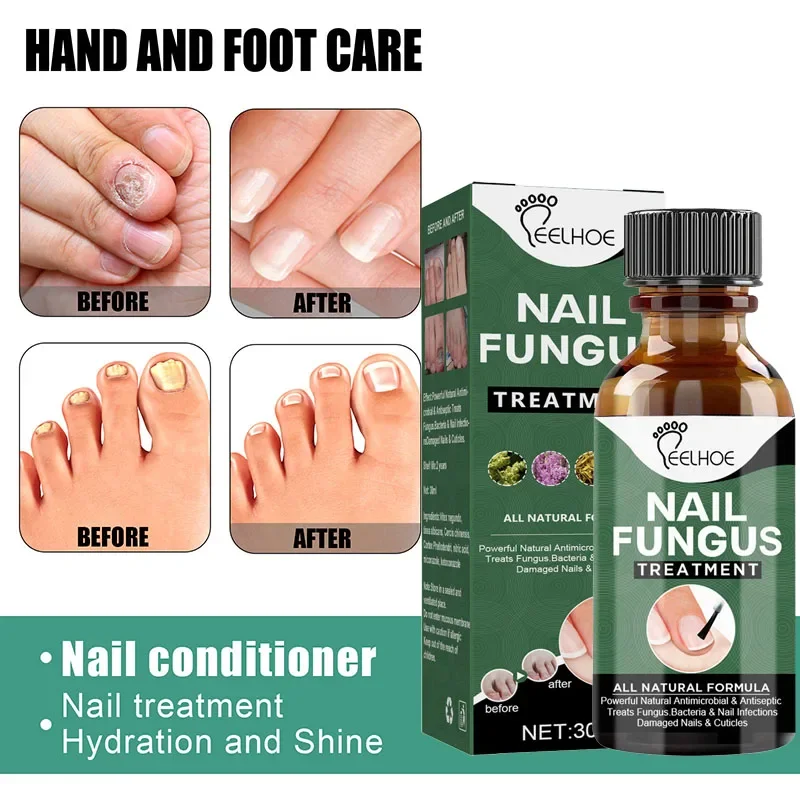 Nail-Fungus-Treatment-Essence-Oil-Toe-Nails-fungal-Removal-Paronychia ...