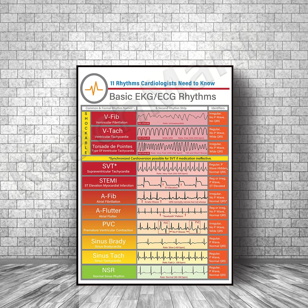 Basic-EKG-ECG-Rhythm-Poster-Nursing-School-Poster-EKG-Study-Guide ...