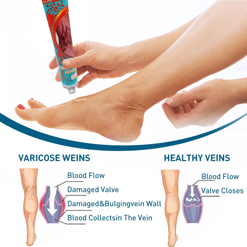 Ungüento para venas varicosas Rojas/azules, 3 piezas, 20g, crema para ...