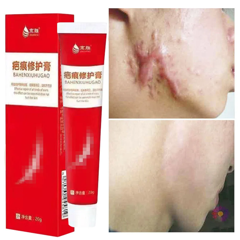 Scar Remover Face Cream Surgical Scald Repair Gel Fade Dark Acne Spot ...