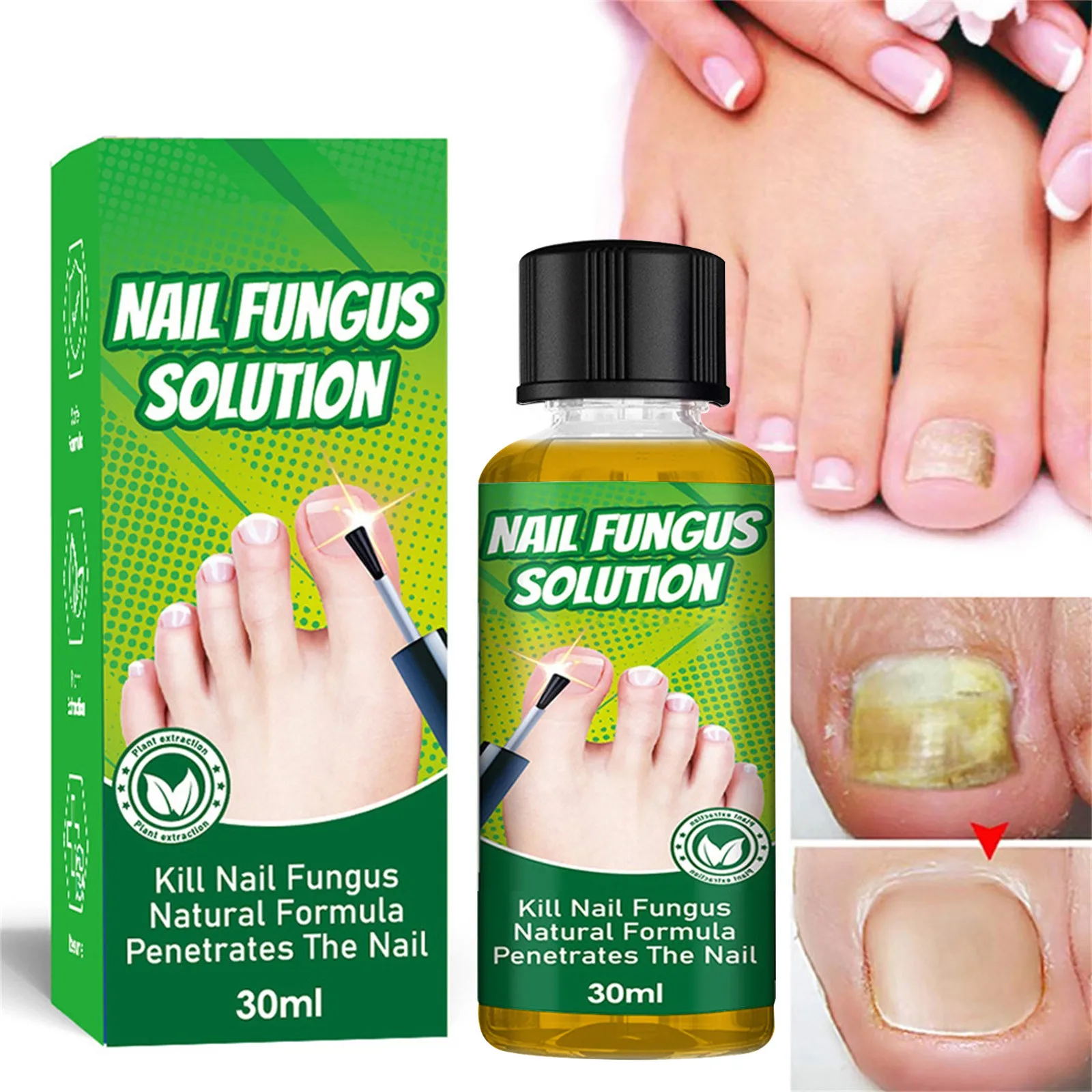 30ml-Toenail-Fungus-Care-FastActing-Nail-Care-Liquid-For-Fungus-Under ...