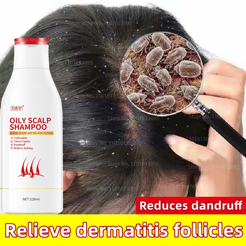 Folliculitis Scalp