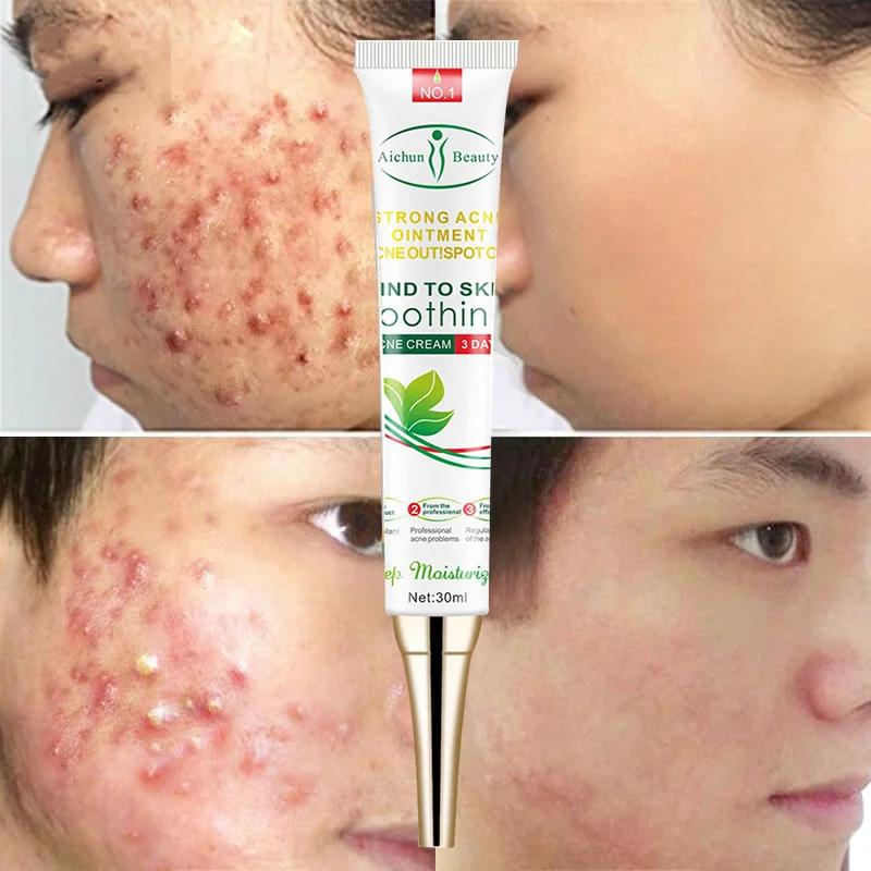 Herbal-Acne-Removal-Cream-Fade-Pimples-Spots-Treatment-Anti-acne-Oil-Control-Acne-Mark-Whitening ...