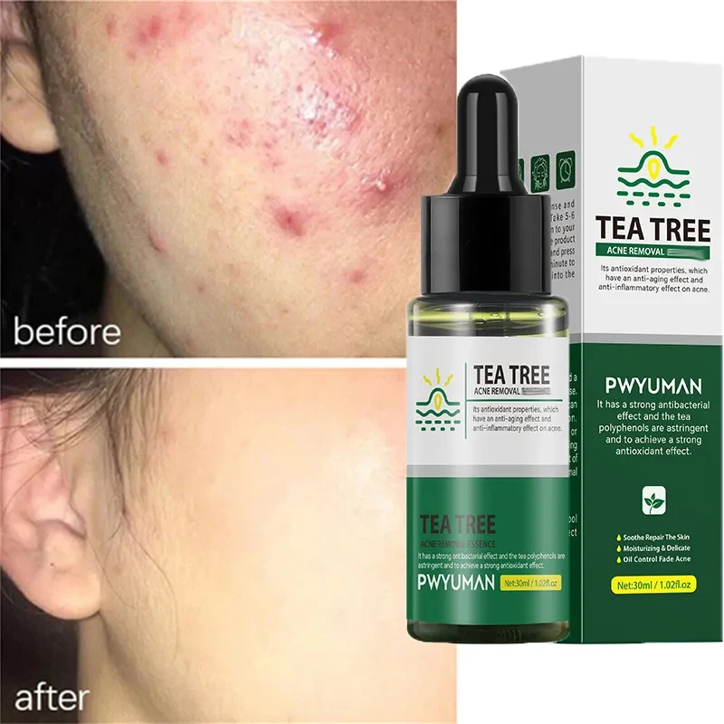 Tea-Tree-Acne-Removal-Serum-Effective-Oil-Control-Acne-Treatment-Repair ...