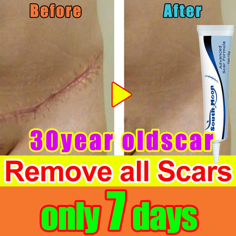 Scar-Removal-Cream-Old-Scar-Cream-Effective-Repair-New-Scars-Surgical ...