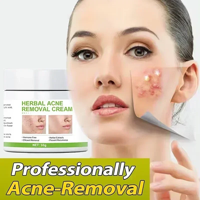 Hot-sales-Effective-Acne-Removal-Comfortable-Acne-removing-Liquid ...