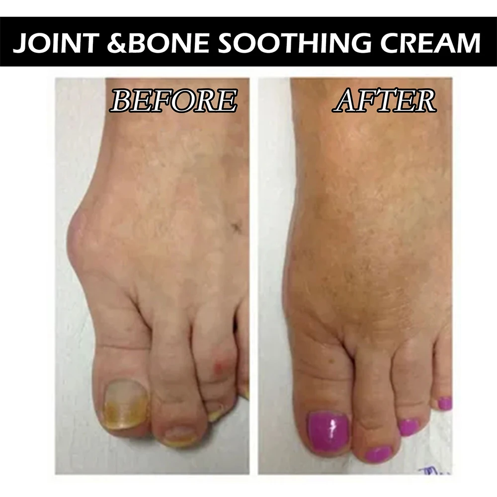 Perfectx Tenosynovitis Treatment - myhomelyproduct