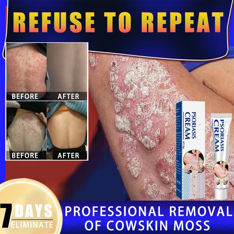 Crema-antibacteriana-para-Psoriasis-tratamiento-efectivo-para ...