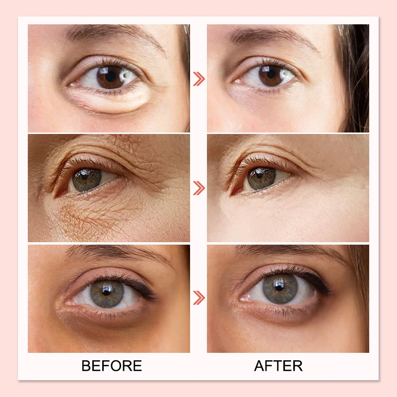 Eyelid Wrinkle Cream