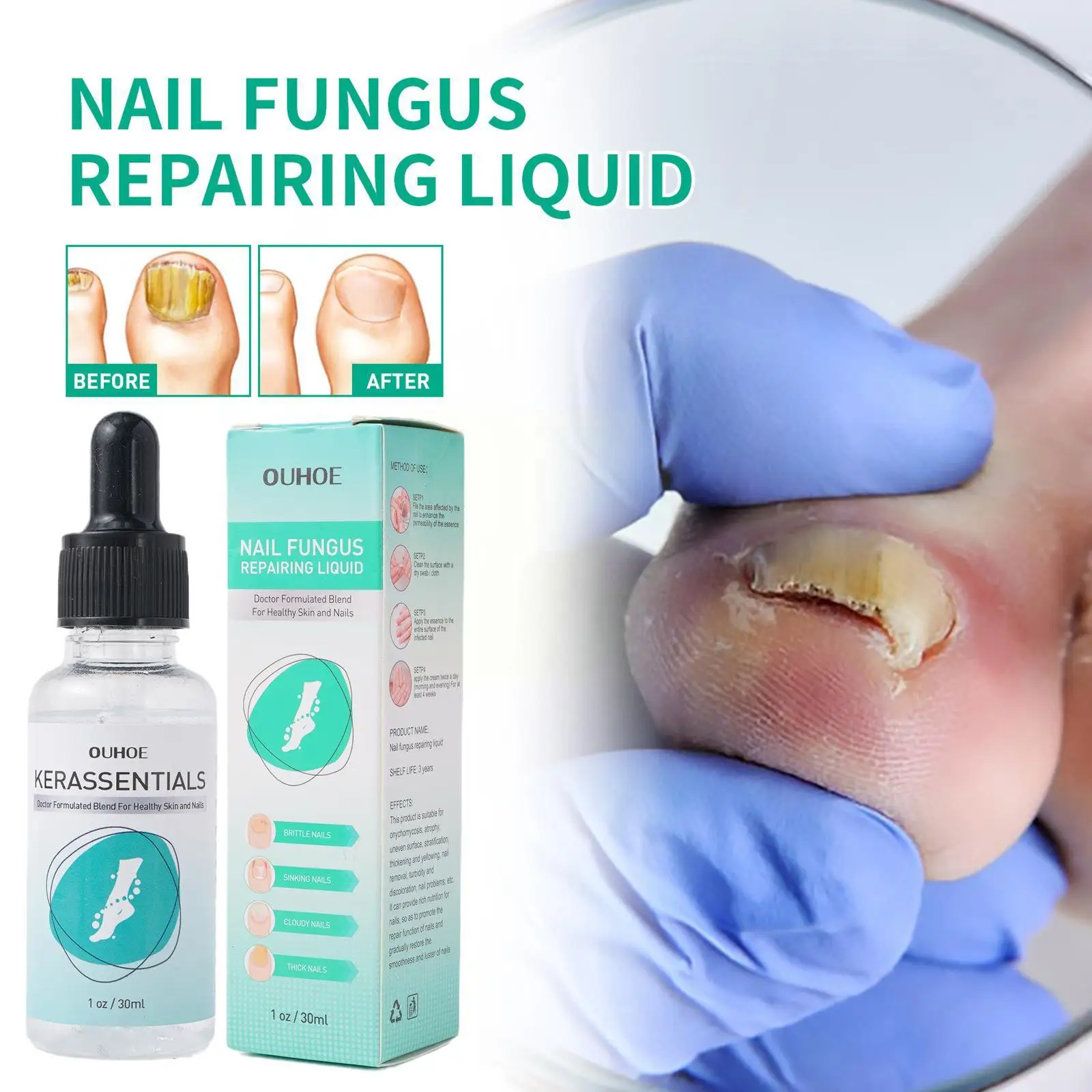 Nail Fungal Treatment Feet Care Essence Anti Infection Foot ...