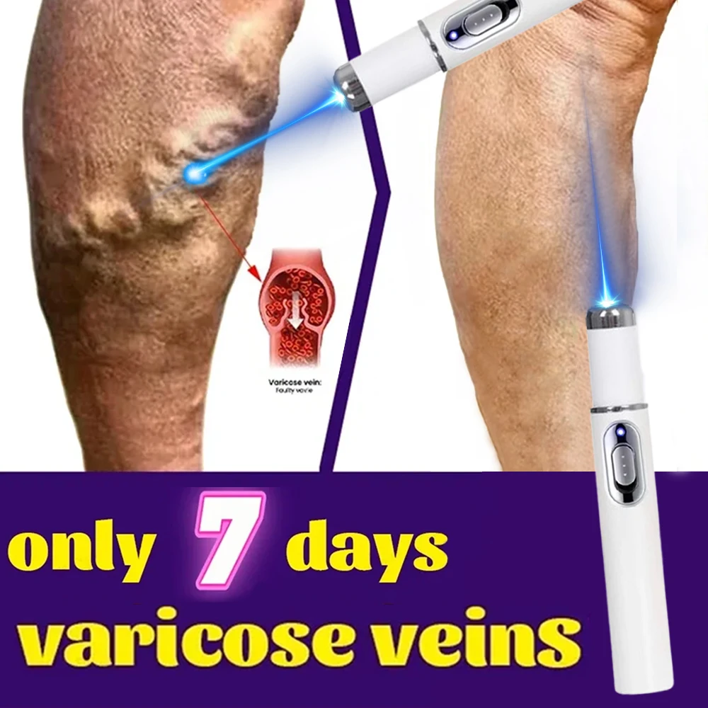 Varicose-Vein-Removal-Laser-Therapy-Spider-Vein-Removal-Treatment ...