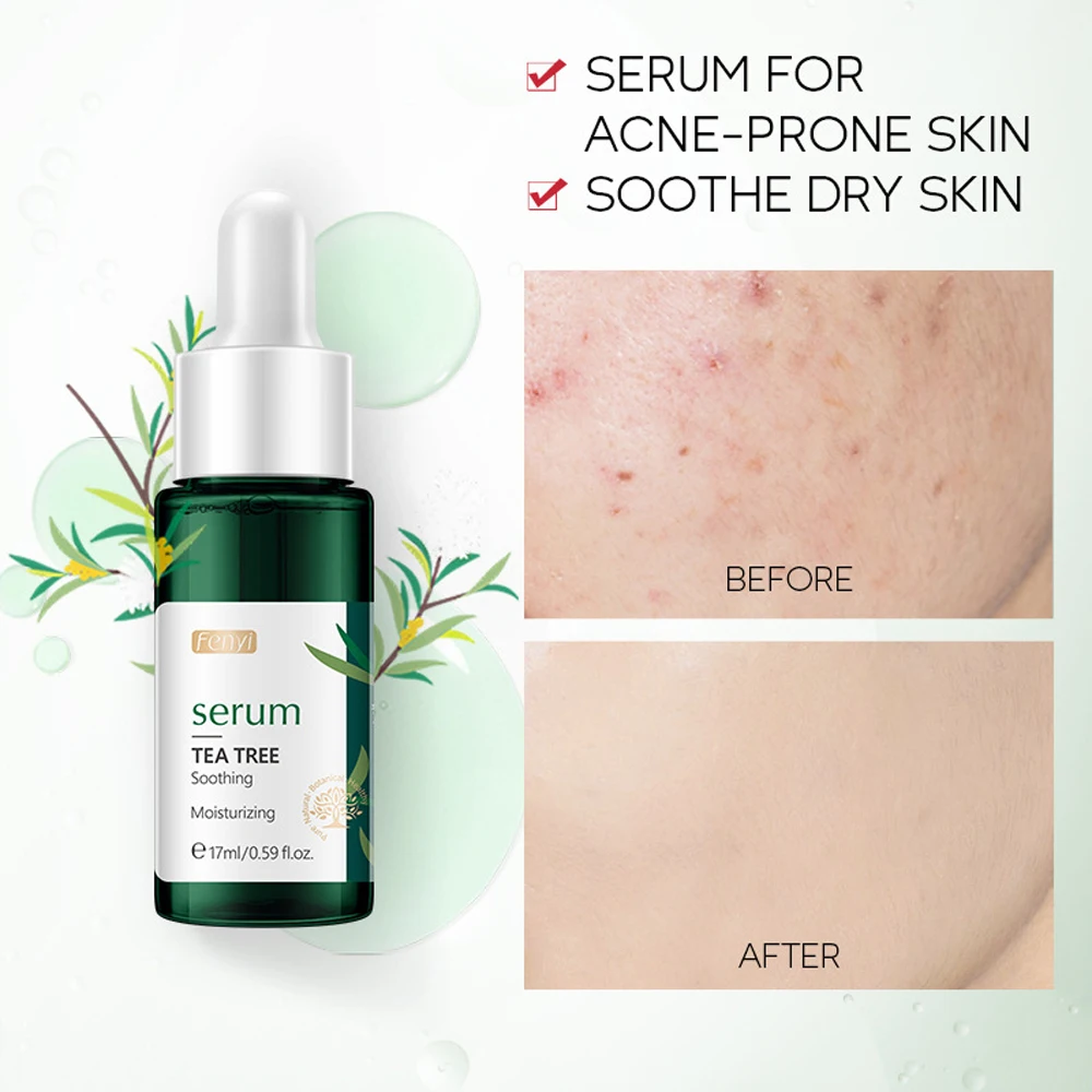 FENYI-Anti-Acne-Skin-Care-Essence-Soro-Tea-Tree-Hidratante-Remover-Acne ...