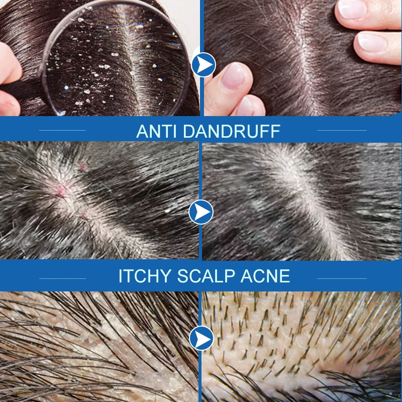 Dandruff Scalp Treatment