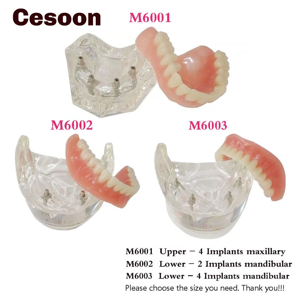 Dental Implant Teeth Model 4/2 Implants Overdenture Restoration Acrylic ...