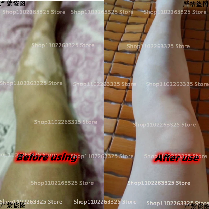 Whitening And Fading Cream To Remove Melanin And Fade Spots To Whiten ...