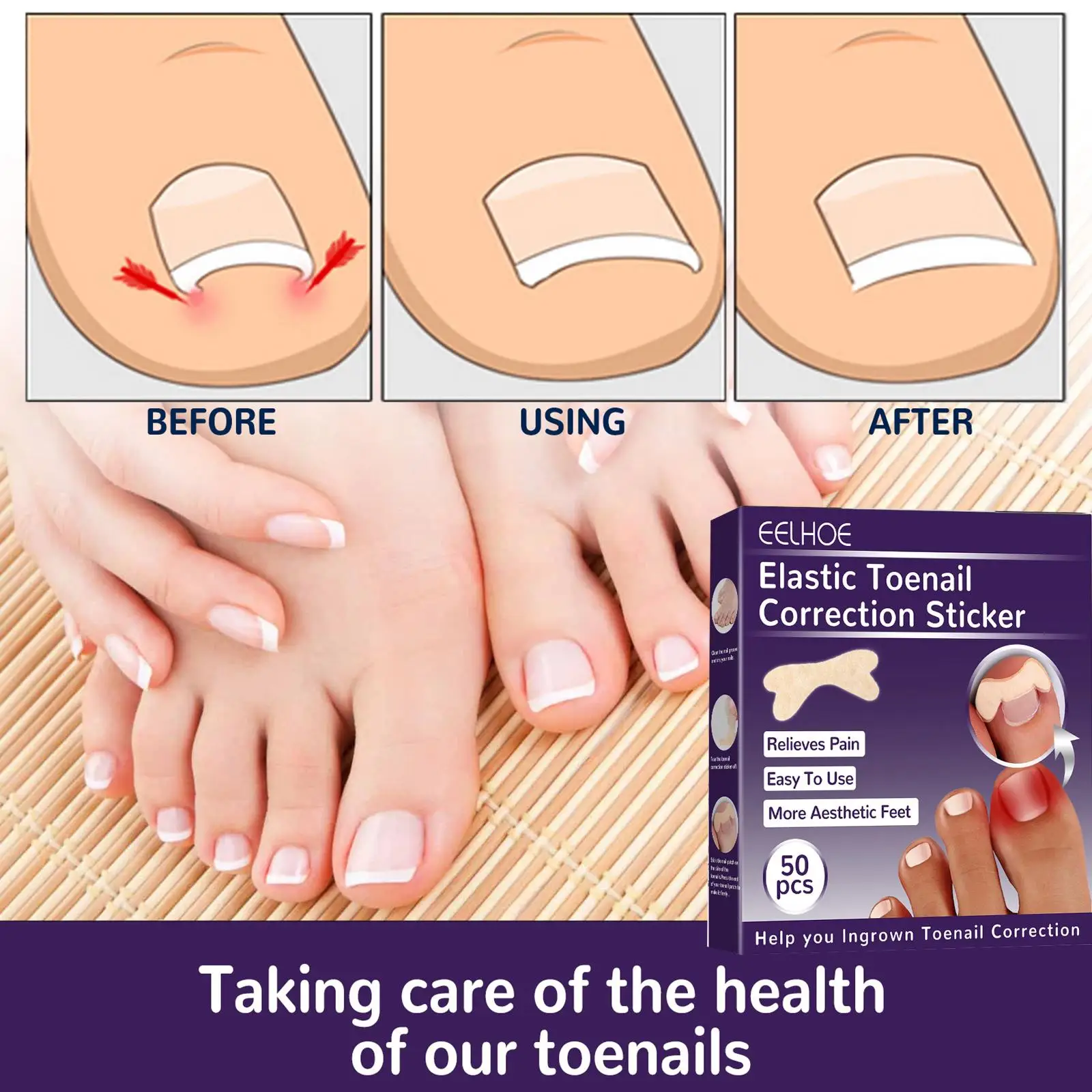 50pcs Nail Ingrown Correction Sticker Treatment Paronychia Relief Pain ...