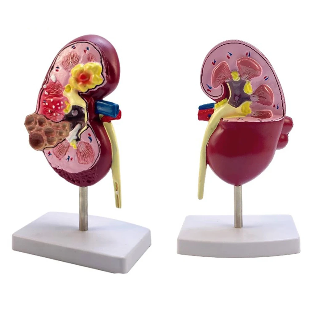 Normal-and-Pathology-Kidney-Anatomical-Model-Diseased-Kidney-Urinary ...