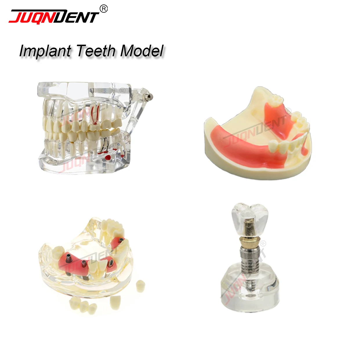 Dental Implant Teeth Model Dental Teaching Model Dentistry Dentist Demo ...