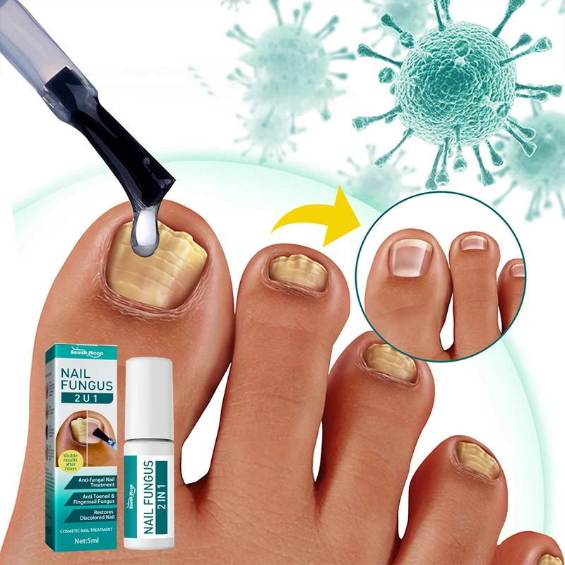 Tratamentos-unha-fungo-Soro-Spray-Repair-Toe-Nail-Fungal-Remo-o-Ess ...