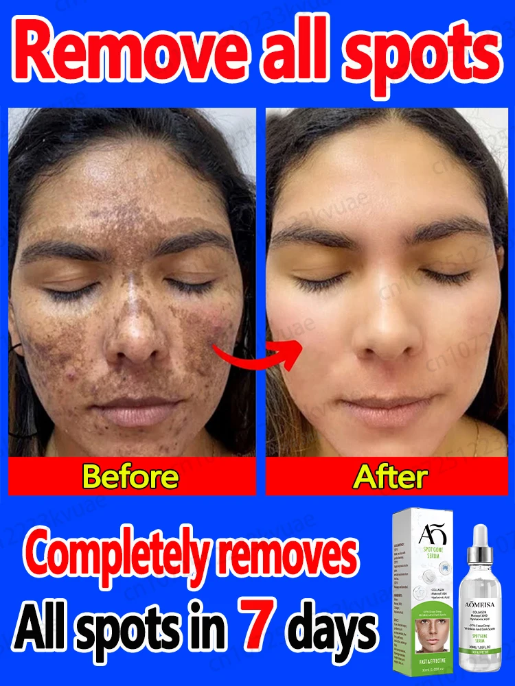 Anti-freckle-serum-to-remove-facial-dark-spots-chloasma-freckles ...
