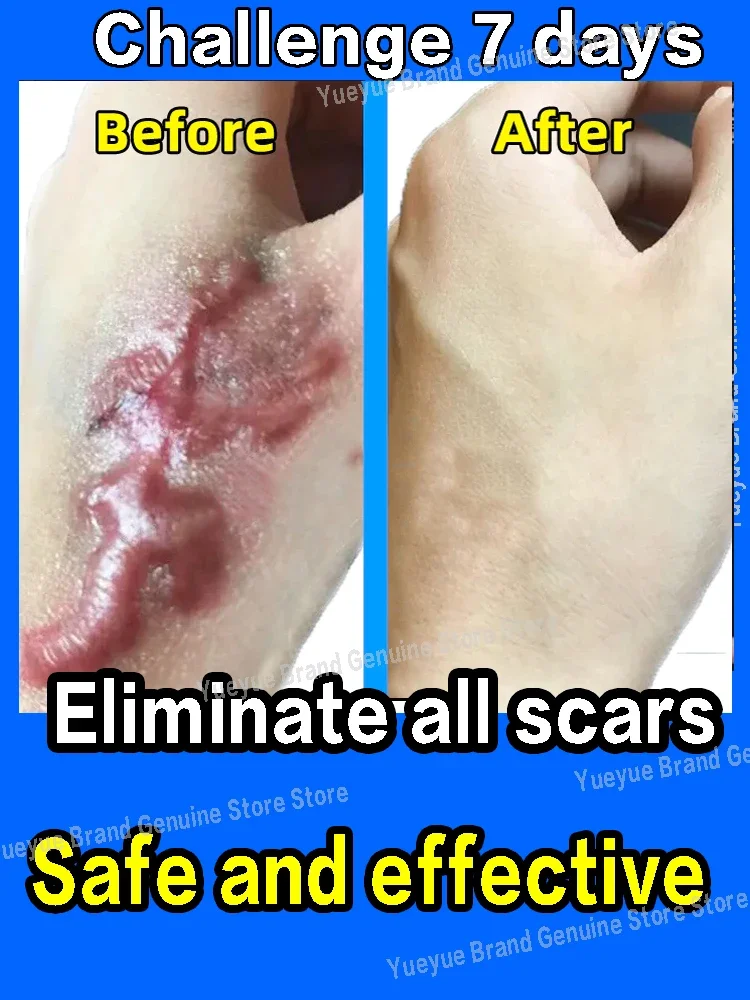 Scar Repair Burns Caesarean Section Stretch Marks Surgical Scars