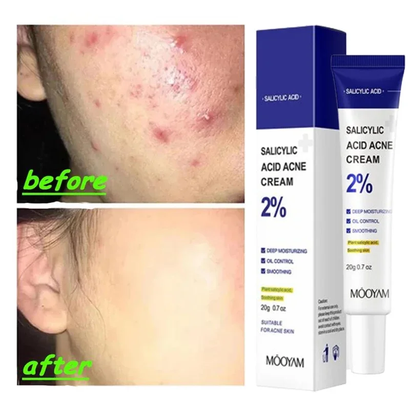 Salicylic-Acid-Acne-Treatment-Cream-Acne-Remover-Face-Cream-Remove-Deep ...