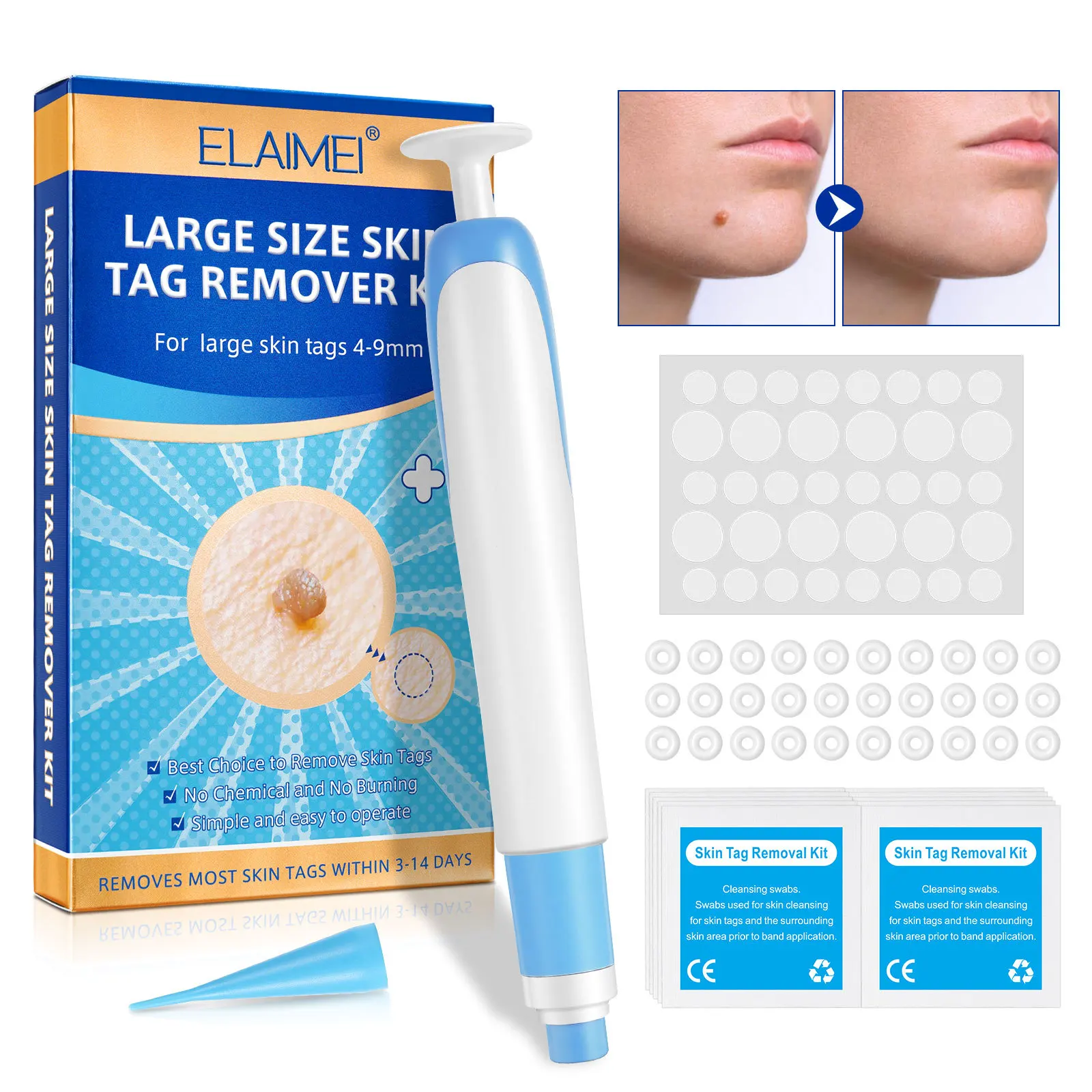 Auto Large Size Skin Tag Removal Kit For Large Skin Tags 4-9mm With ...