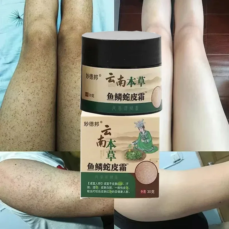 Chicken-Skin-Repair-Cream-Curing-Keratosis-Follicle-Pilaris-Body-Dark ...