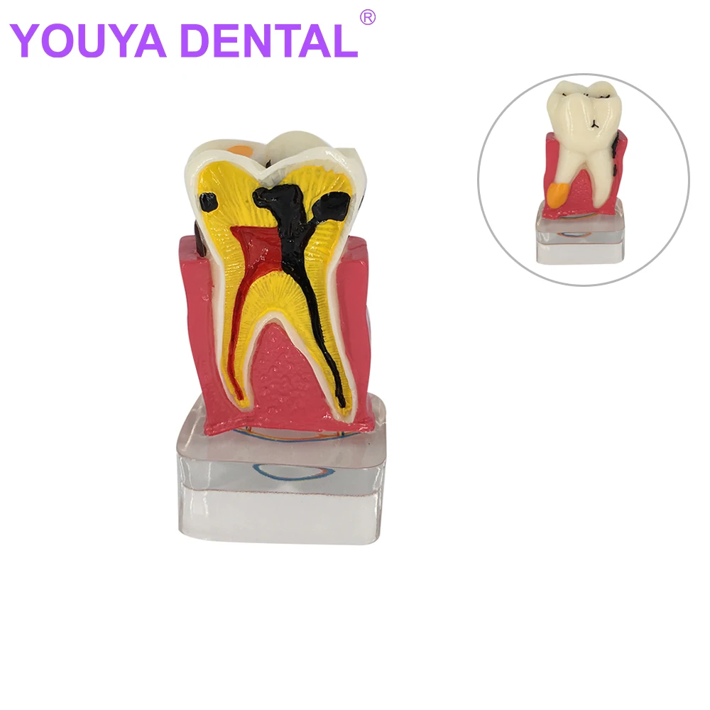 4-Times-Dental-Anatomy-Education-Teeth-Model-Transparent-Resin-Molar ...